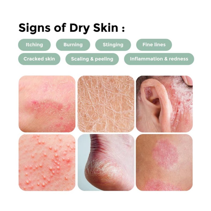Dehydrated Skin Symptoms